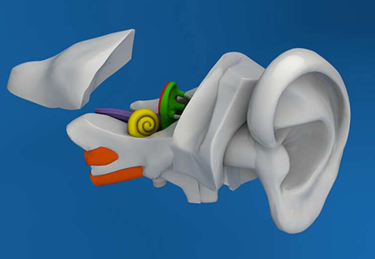 Tympanoplasty - ENT Doctor | Ear and Tinnitus Specialist | Hamid ...